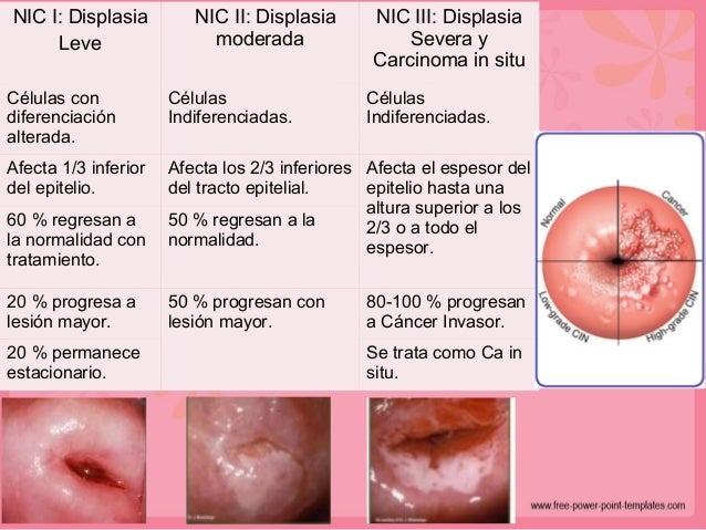 Estadios Del Cáncer De Cérvix Estadios Del Cáncer De Cérvix Axlio