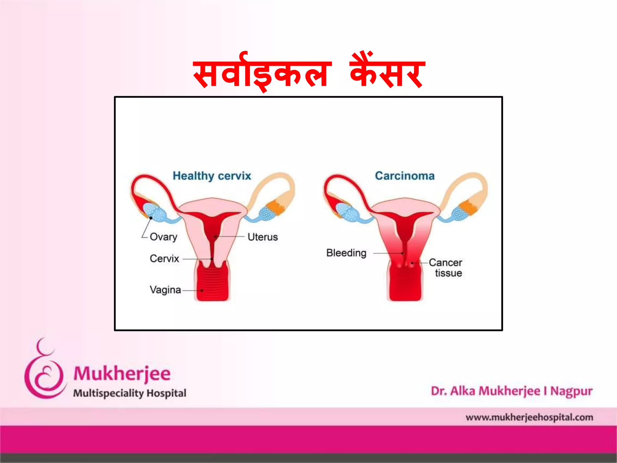Cancer cervix awareness in hindi by dr alka mukherjee nagpur ms india ...