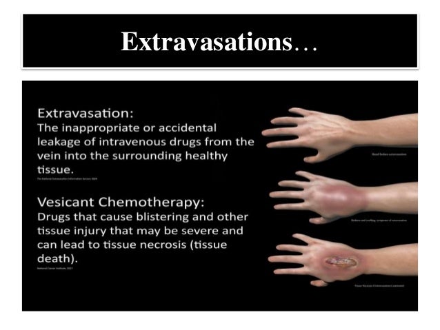 Cancer chemo therapy