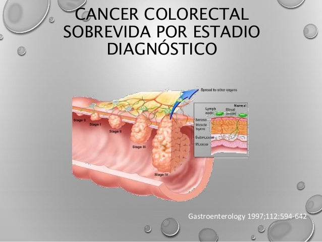 CANCER COLORECTAL Prevención, Diagnóstico y Tratamiento