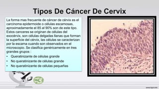 Cancer de cervix | PPTX