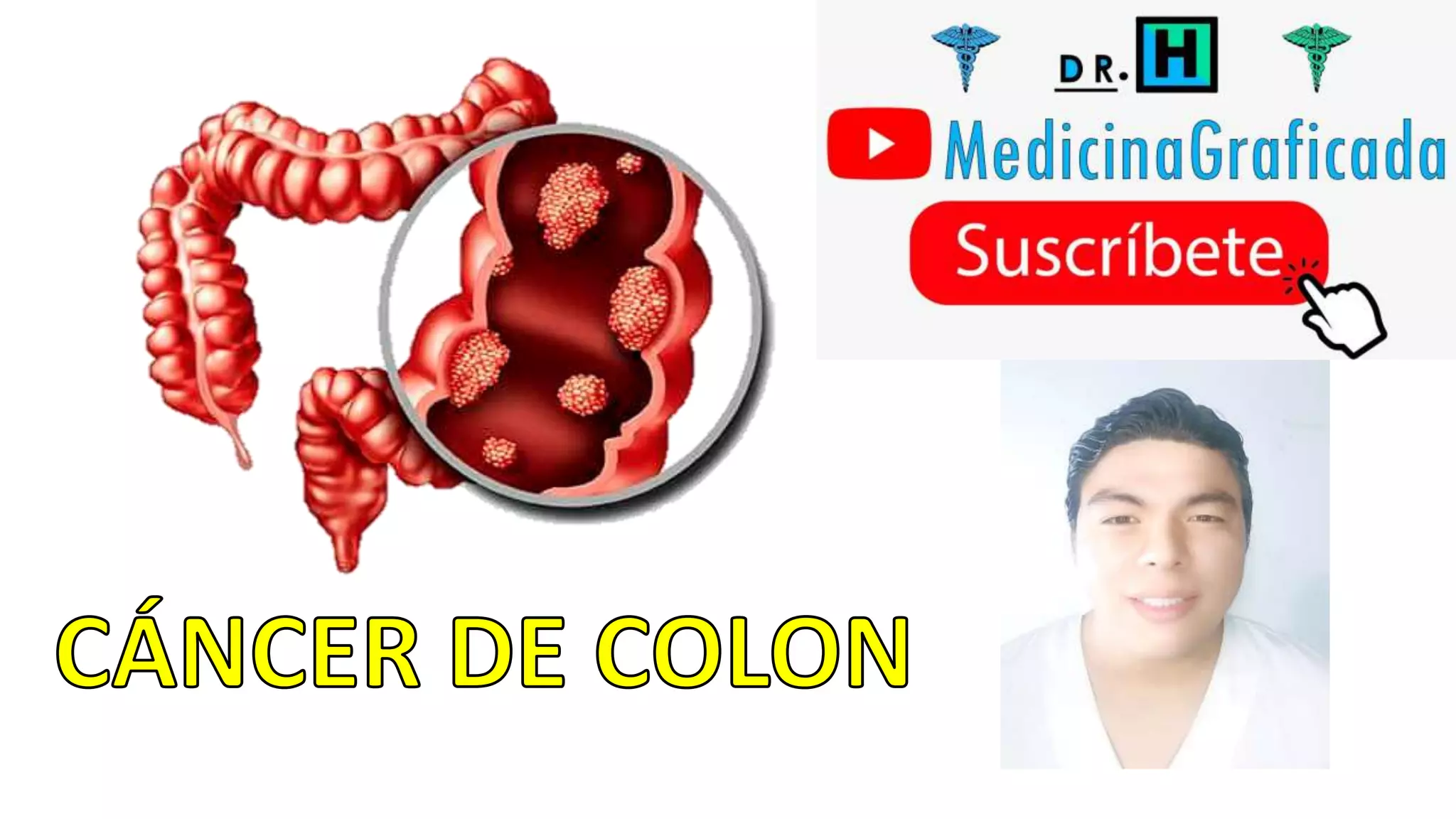 cancer de colon.pptx