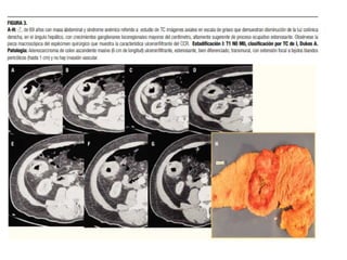 CANCER DE COLON Y RECTO Causas y factores de Riesgo | PPTX