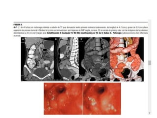 CANCER DE COLON Y RECTO Causas y factores de Riesgo | PPTX
