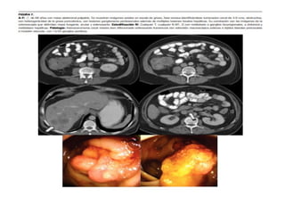 CANCER DE COLON Y RECTO Causas y factores de Riesgo | PPTX