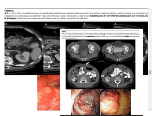 CANCER DE COLON Y RECTO Causas y factores de Riesgo | PPTX