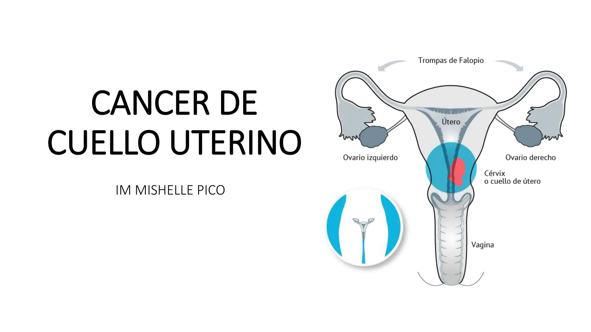 cancer de cuello uterino KKDKFKDKFKDMMVMD.pptx