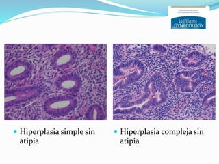 Cancer de endometrio | PPTX