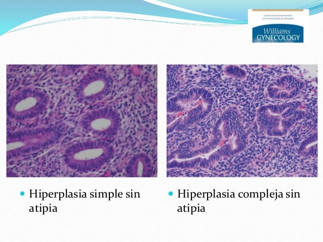 Cancer de endometrio