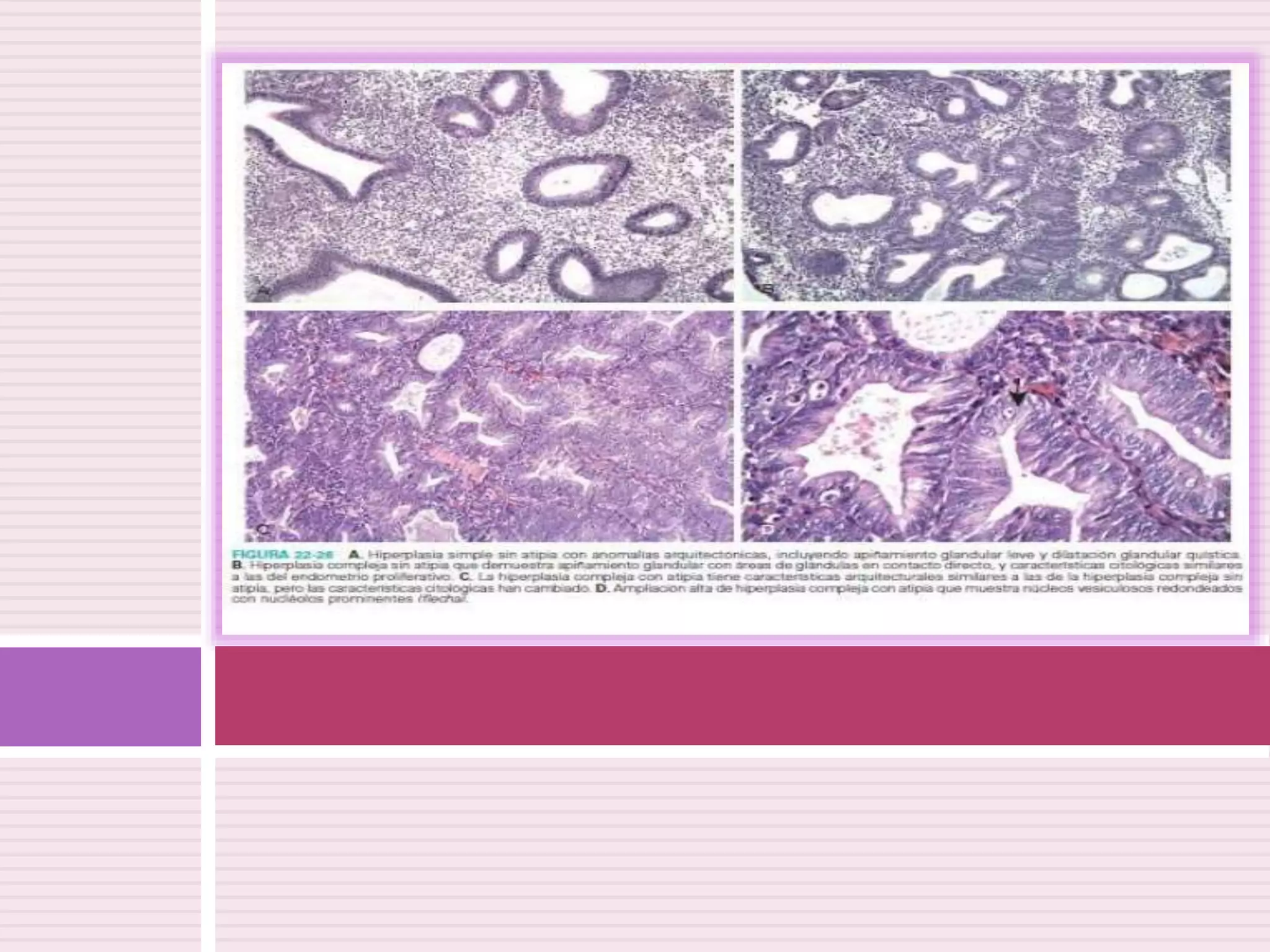 Cancer de endometrio | PPT