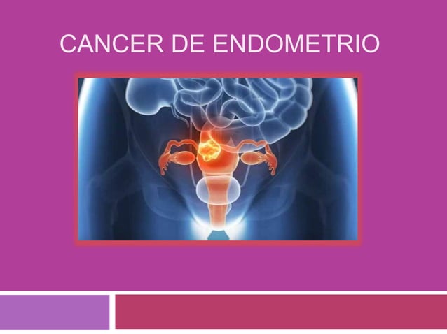 Cancer de endometrio | PPT