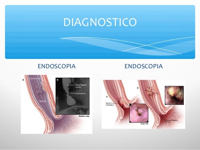 Cancer de esofago. usam