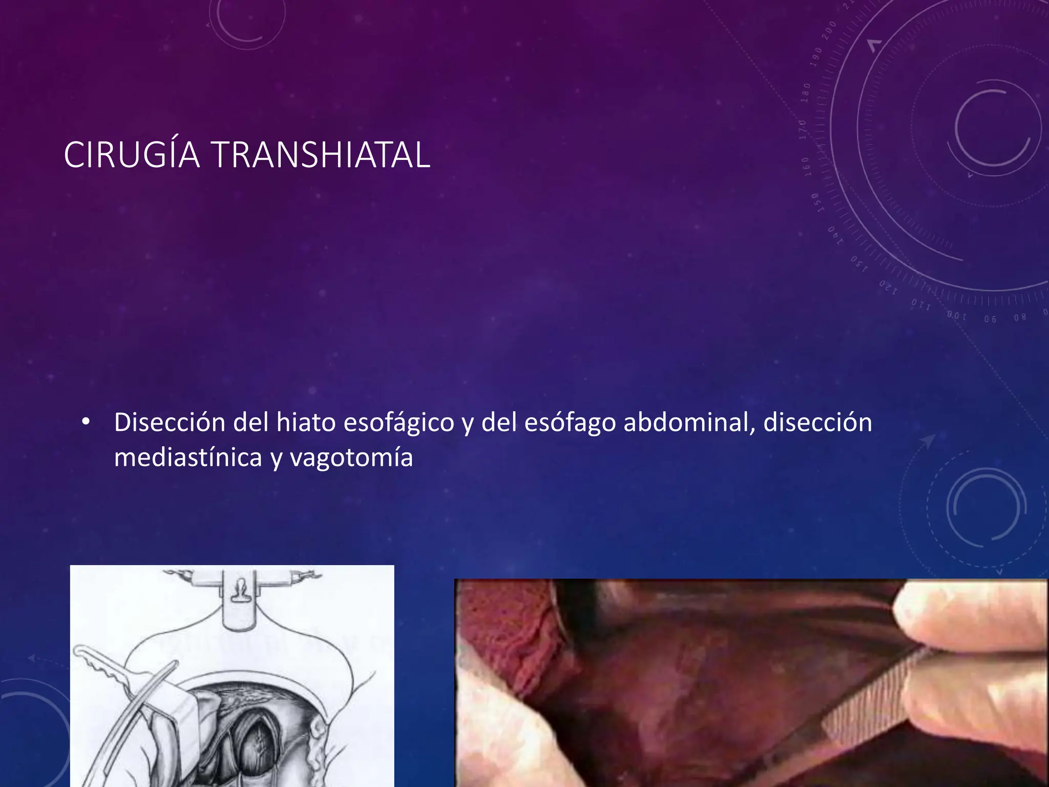 cancer de esofago y acalasia tratamiento quirurgico | PPT