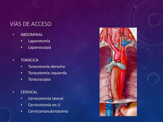 cancer de esofago y acalasia tratamiento quirurgico | PPT