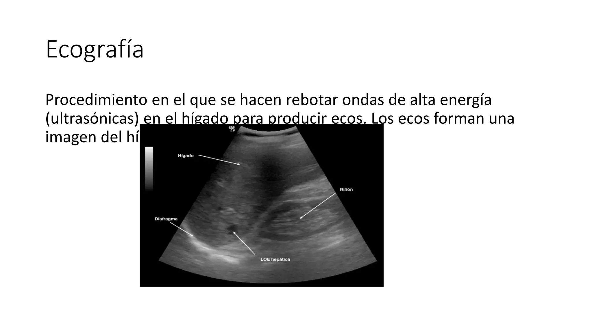 Cancer De Hígado Presentación Powerpoint Ppt