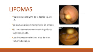 Cancer de intestino delgado | PPTX