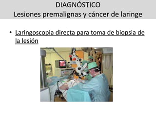 Cancer de laringe | PPTX