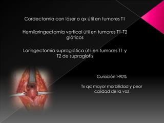 Cancer de laringe e hipofaringe | PPTX