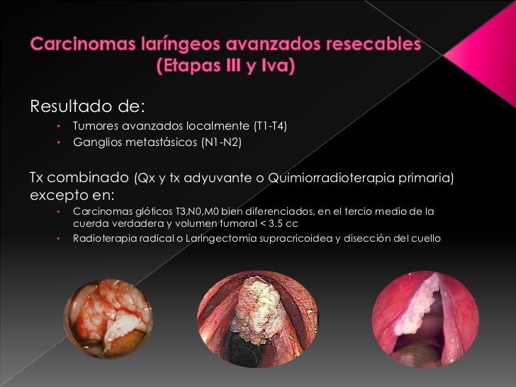 Cancer de laringe e hipofaringe