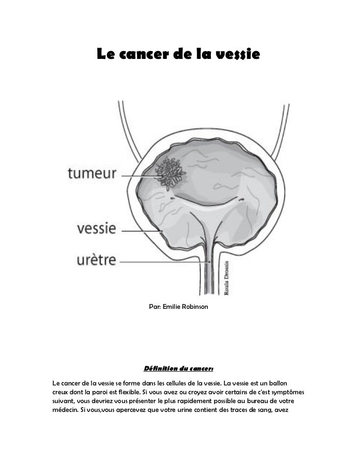Cancer de la vessie Cancer de la vessie