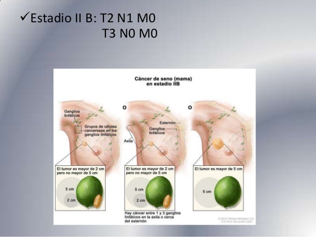 Cáncer de Mama