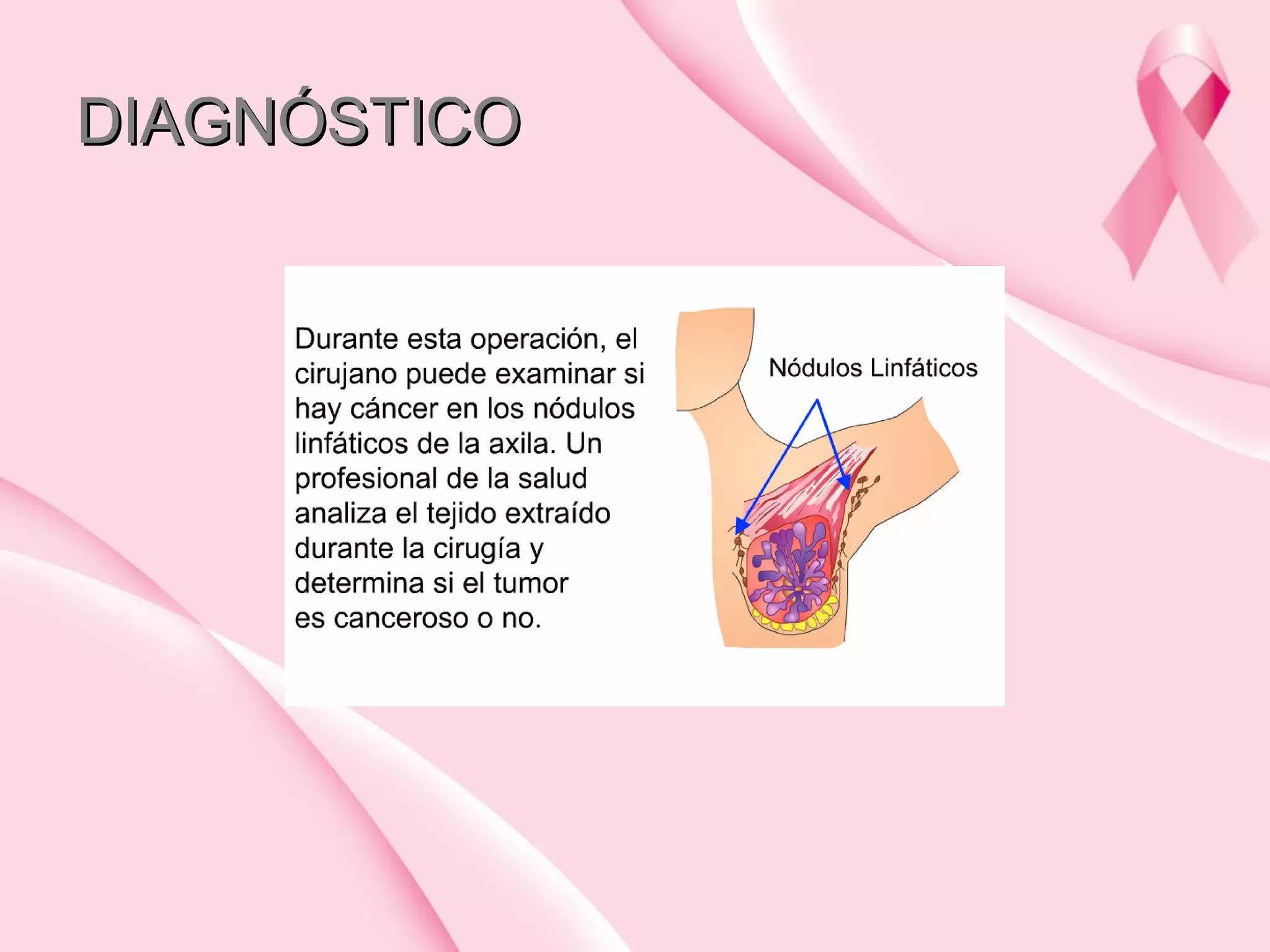 Cancer de mama | PPT