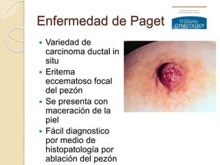 Cáncer de mama | PPTX