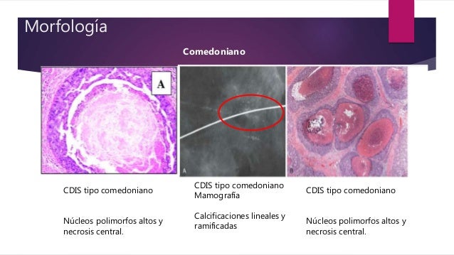 Cáncer de mama (adenocarcinoma) y bases moleculares