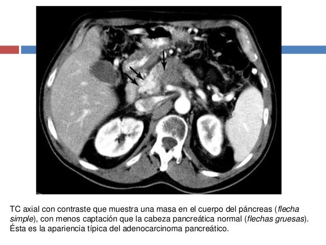 Cancerdepancreas