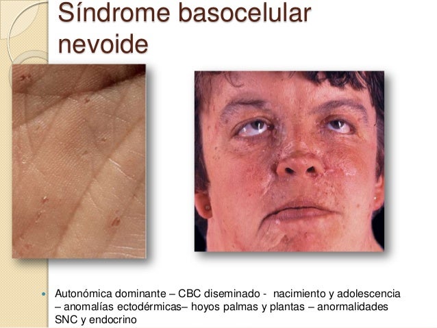 Sindrome Do Carcinoma Basocelular Nevoide Carcinoma Basocelular. Caso