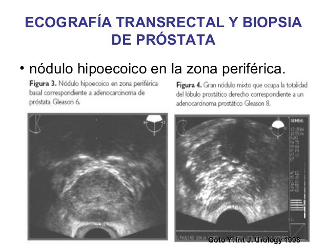 Cancer de prostata