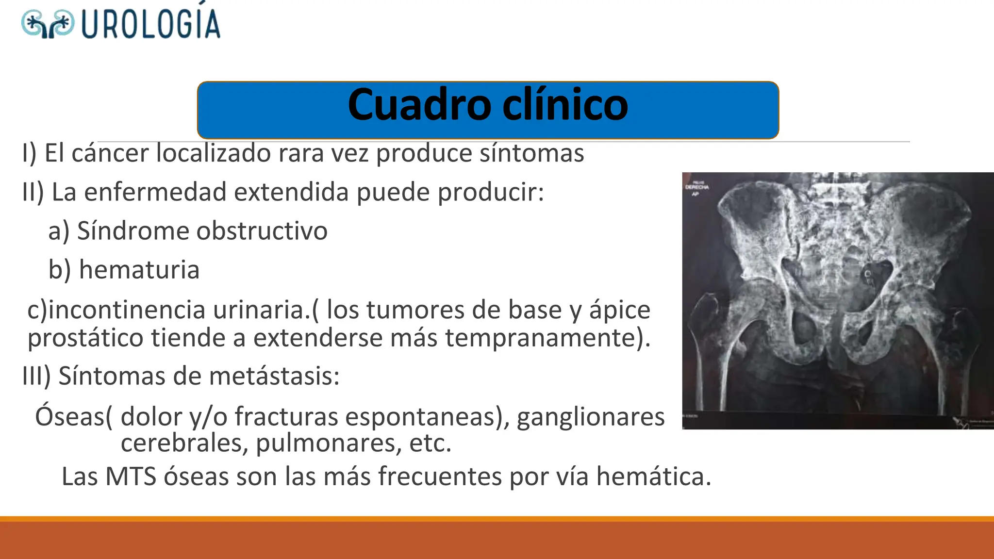 CANCER DE PROSTATA.pptx definición, causas | PPT