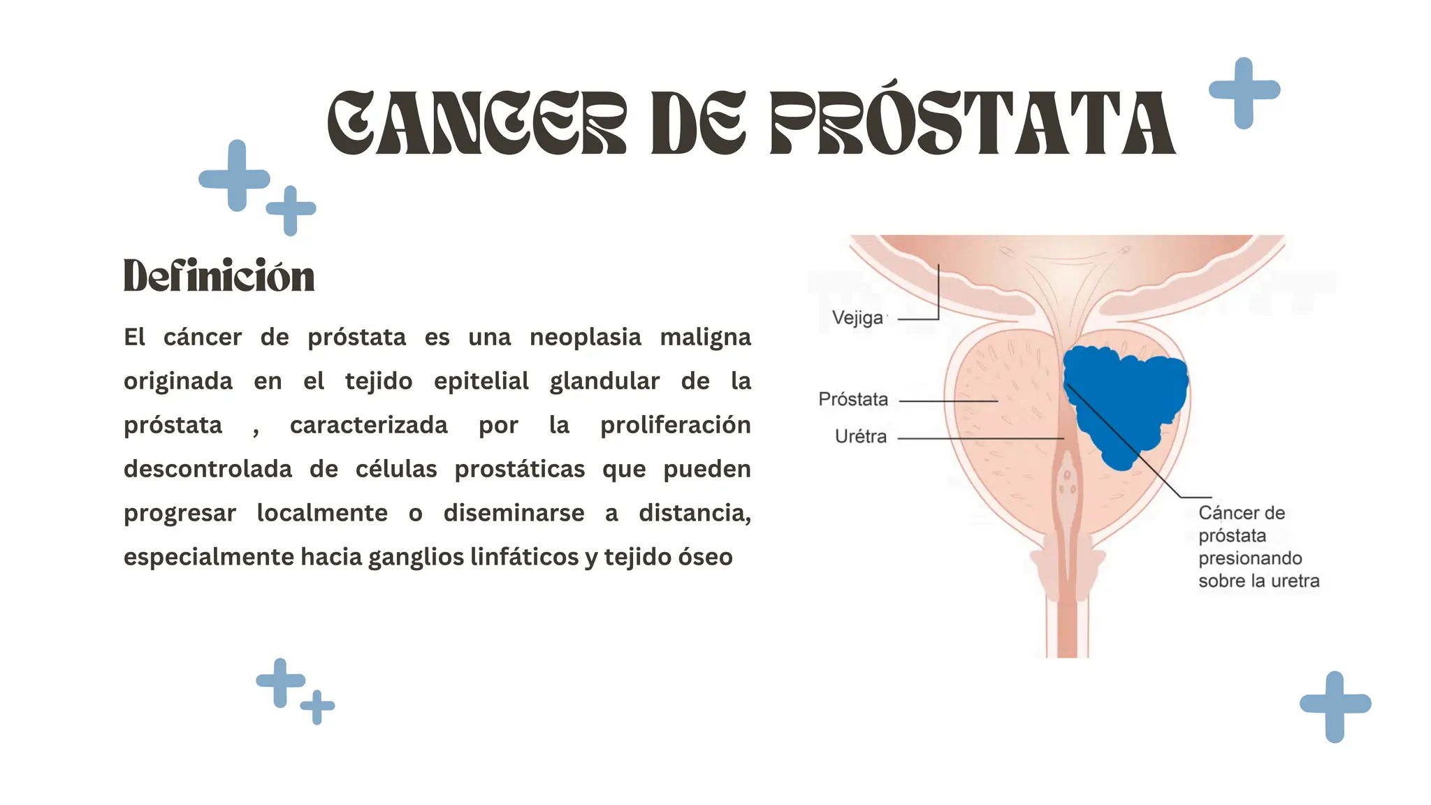 CANCER DE PRÓSTATA,UROLOGIA CORUGIA TRES | PDF