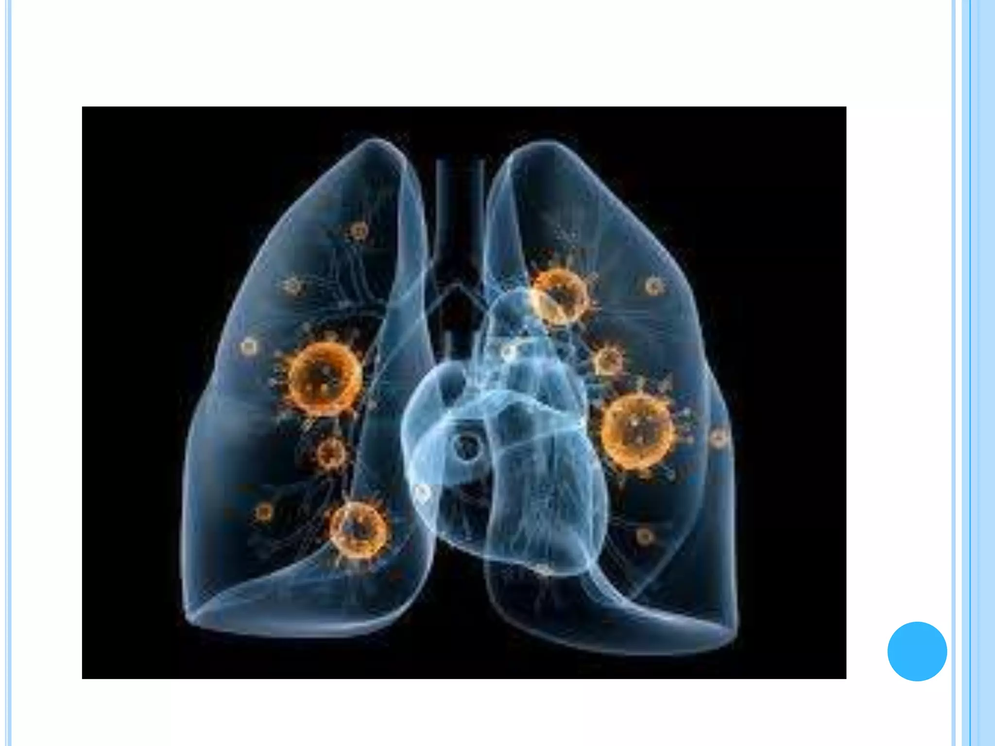 Cancer De Pulmon Ppt
