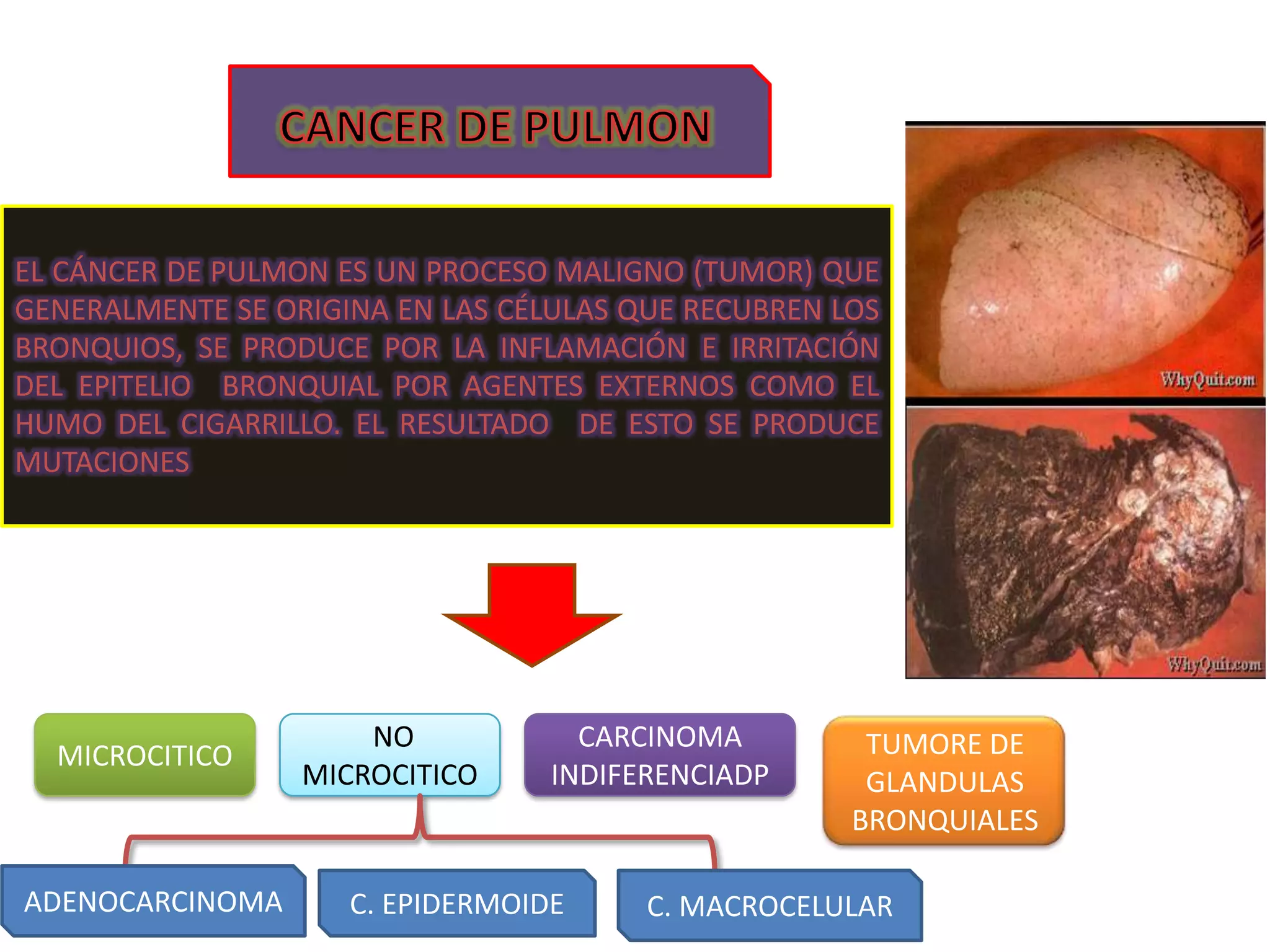 Cancer de pulmon no microcitico ( | PPT
