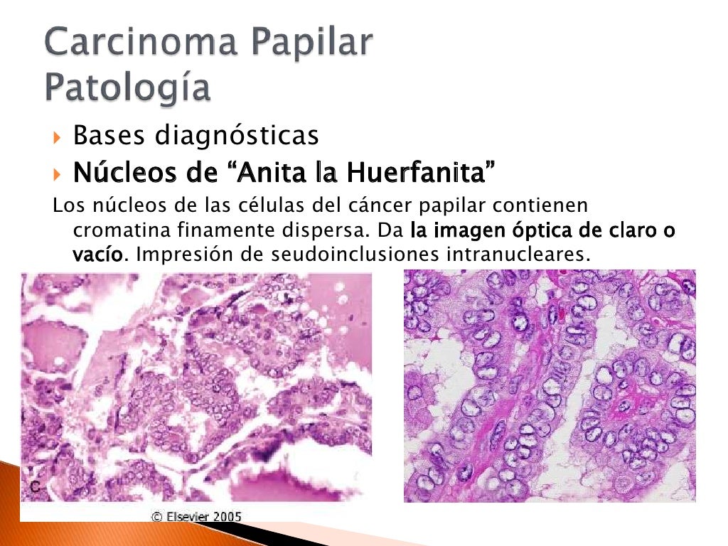 Cancer de tiroides