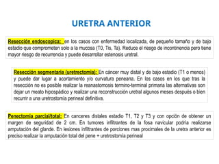 Tratamiento Integral del Cáncer de Uretra: Diagnóstico, Clasificación y ...
