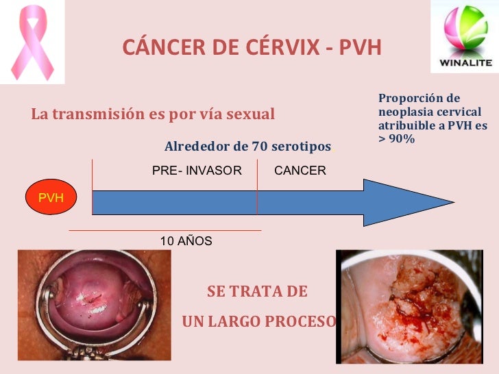 Cancer De Utero Eli