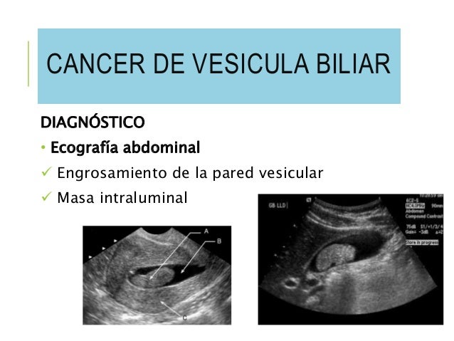 Cancer de vesicula biliar