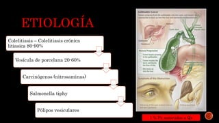 CANCER DE VESICULA BILIAR.pptx