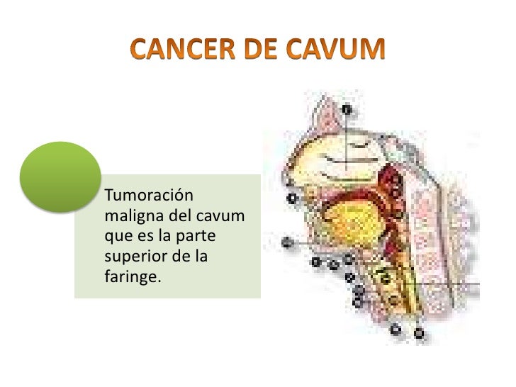 Cancer de vias aerodigesivas superiores