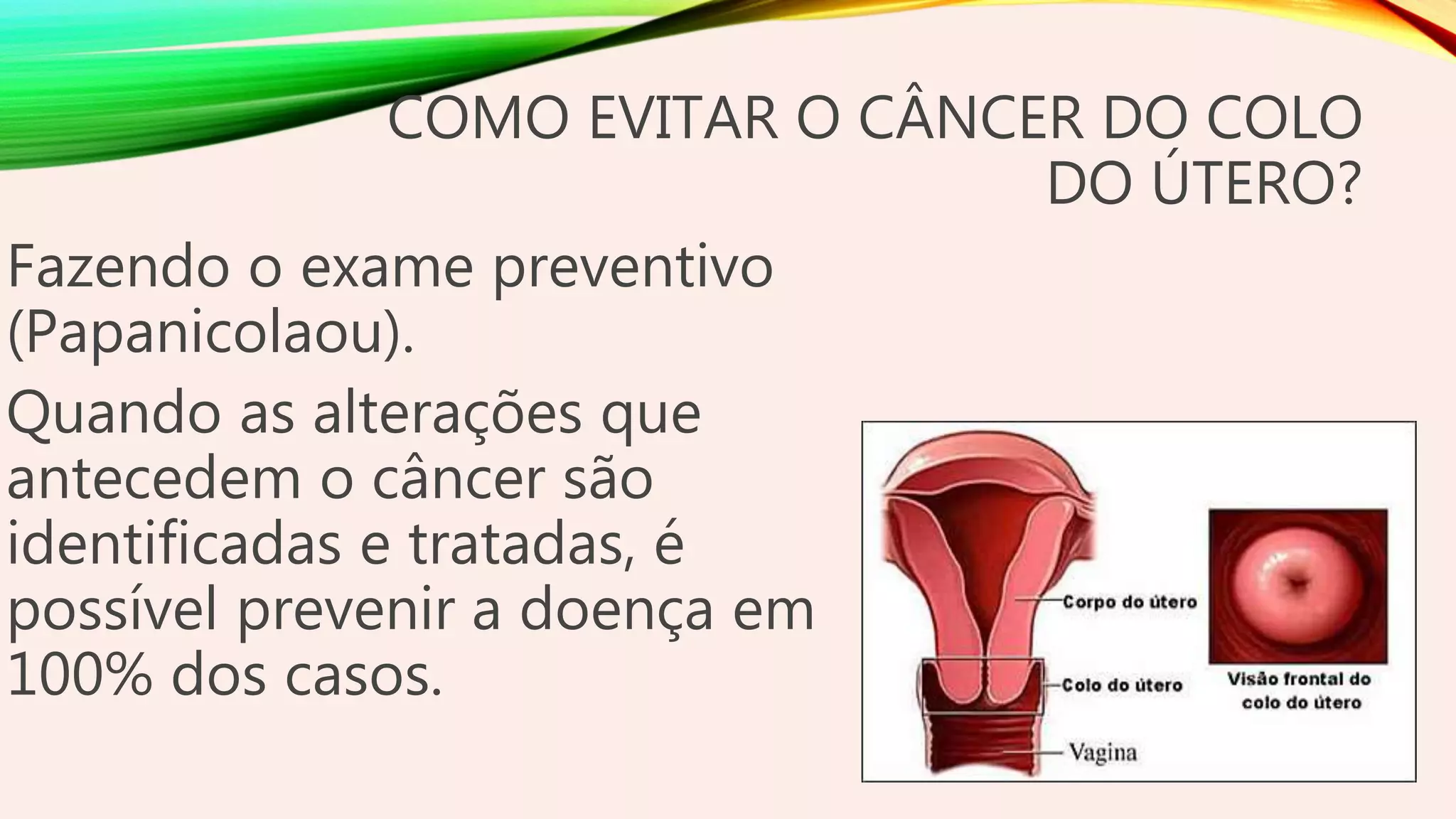 Cancer do cólo do útero pronto | PPTX