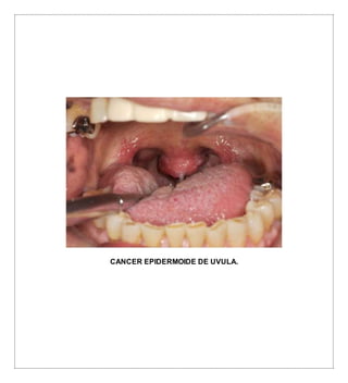 Uvula Cancer