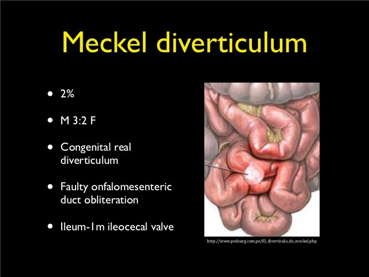 Diverticulums - Bowel cancer