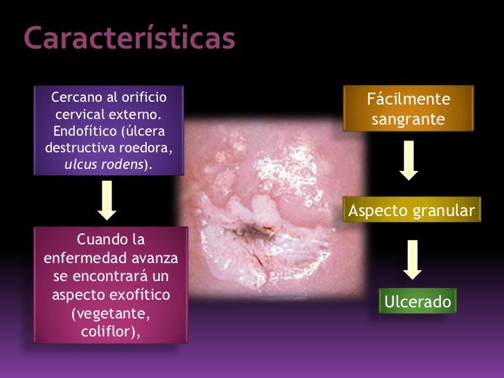 Cncer De Cuello Uterino Causas Y Sntomas Que Debes