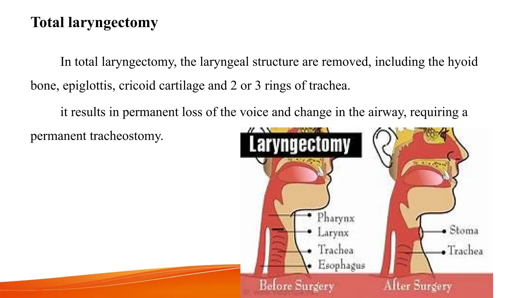 CANCER OF LARYNX AND ITS DETAILED MANAGEMENT | PPTX