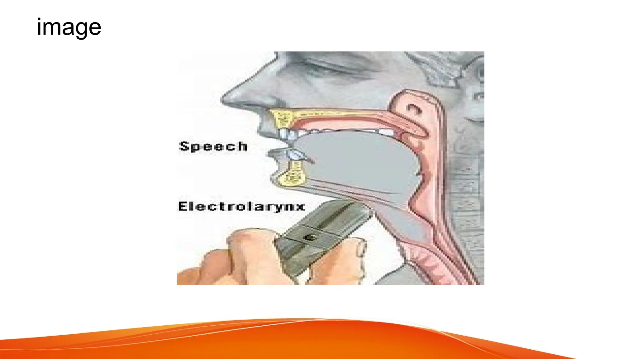 CANCER OF LARYNX AND ITS DETAILED MANAGEMENT | PPTX
