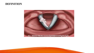 CANCER OF LARYNX AND ITS DETAILED MANAGEMENT | PPTX