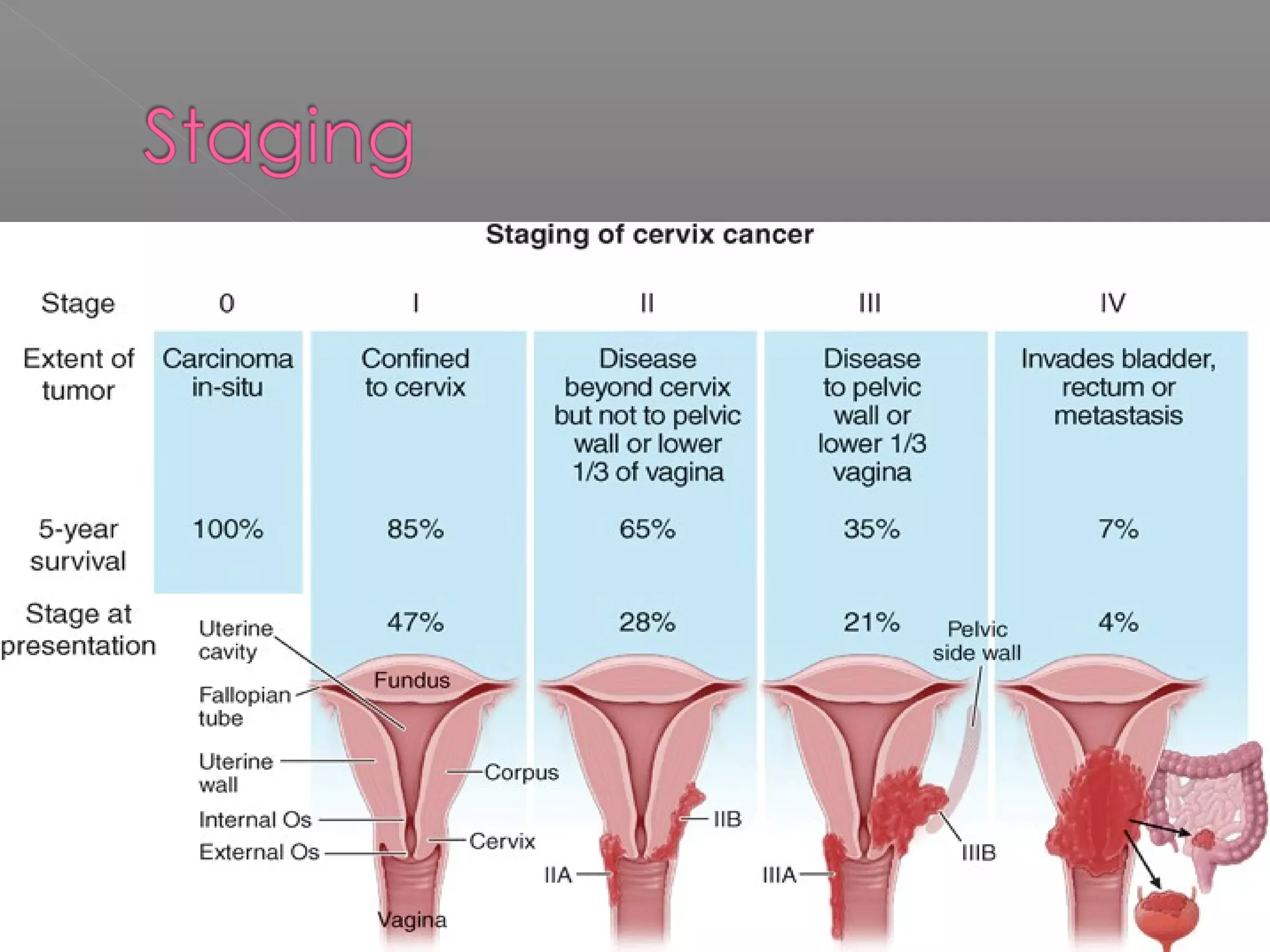 Cancer of cervix | PPT