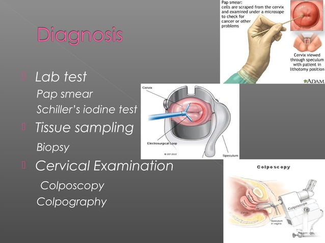Cancer Of Cervix Ppt Cancer Diseases And Conditions